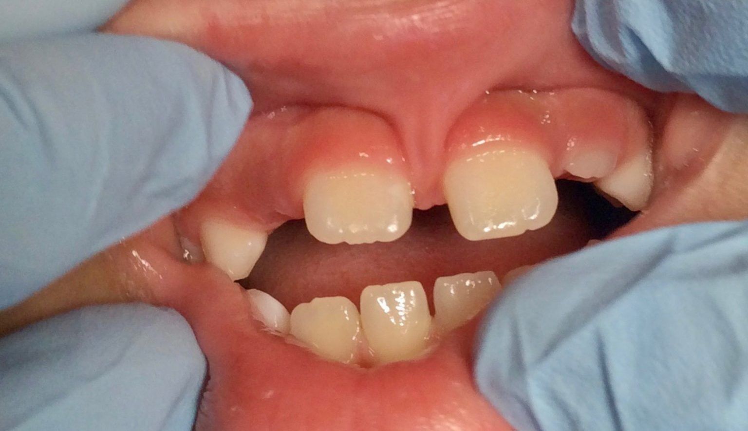 Infant Frenectomies Explained: What Parents Should Expect - Children's ...